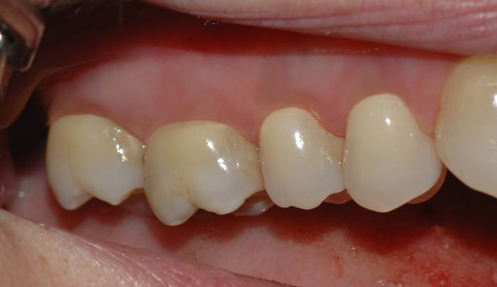Ising – Børsteskader - Sentrum Dental